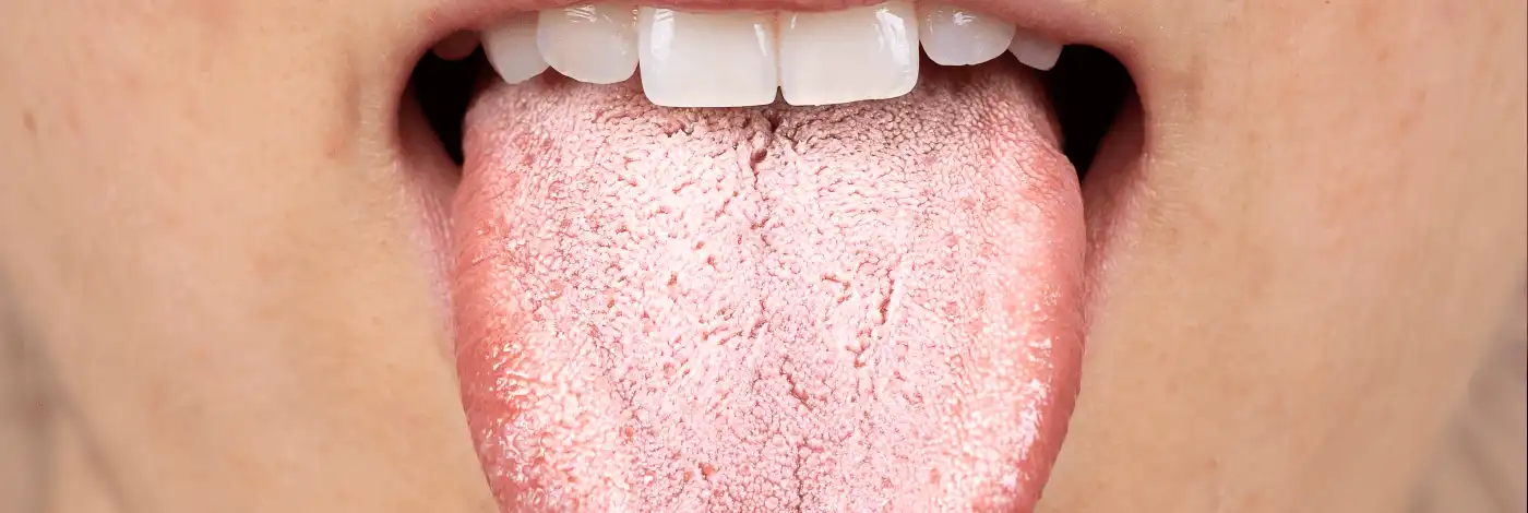 Candidíase oral: Abordagem clínica e como realizar o tratamento